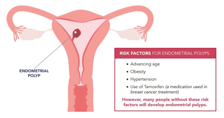Complete Guide to Endometrial Polyps - Symptoms & Treatment